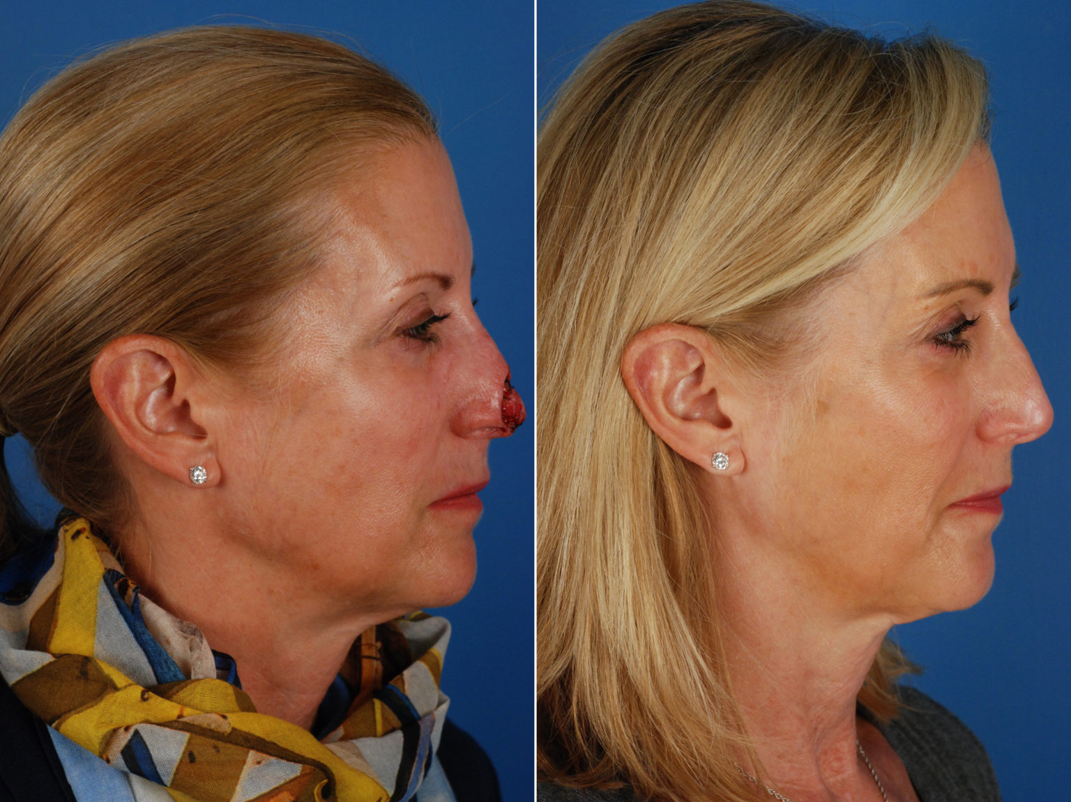 Mohs Surgery in Naples, FL | Aesthetic Surgery Center