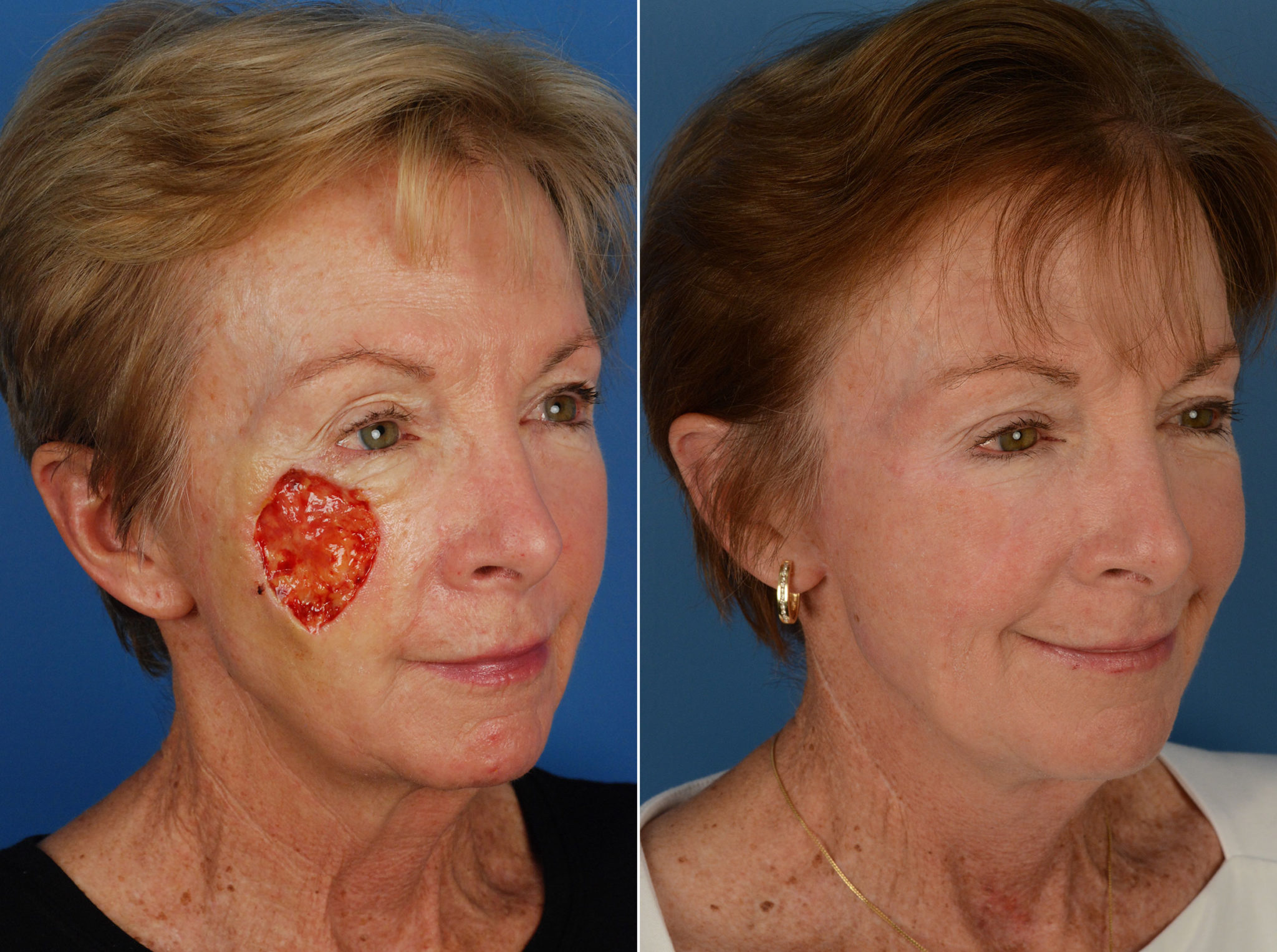 Skin Cancer Reconstruction Photos Naples FL Patient 12033 Skin Cancer Reconstruction Photos Naples FL Patient 12033