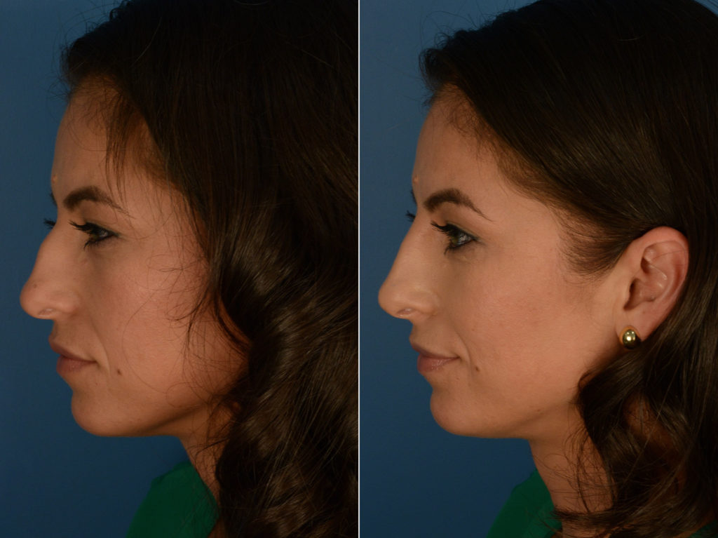 Injectable Filler Rhinoplasty Photos | Naples, FL | Patient 15590