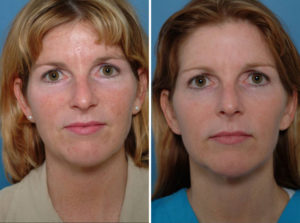 How to Restore Collagen in the Face and Reverse Signs of Aging
