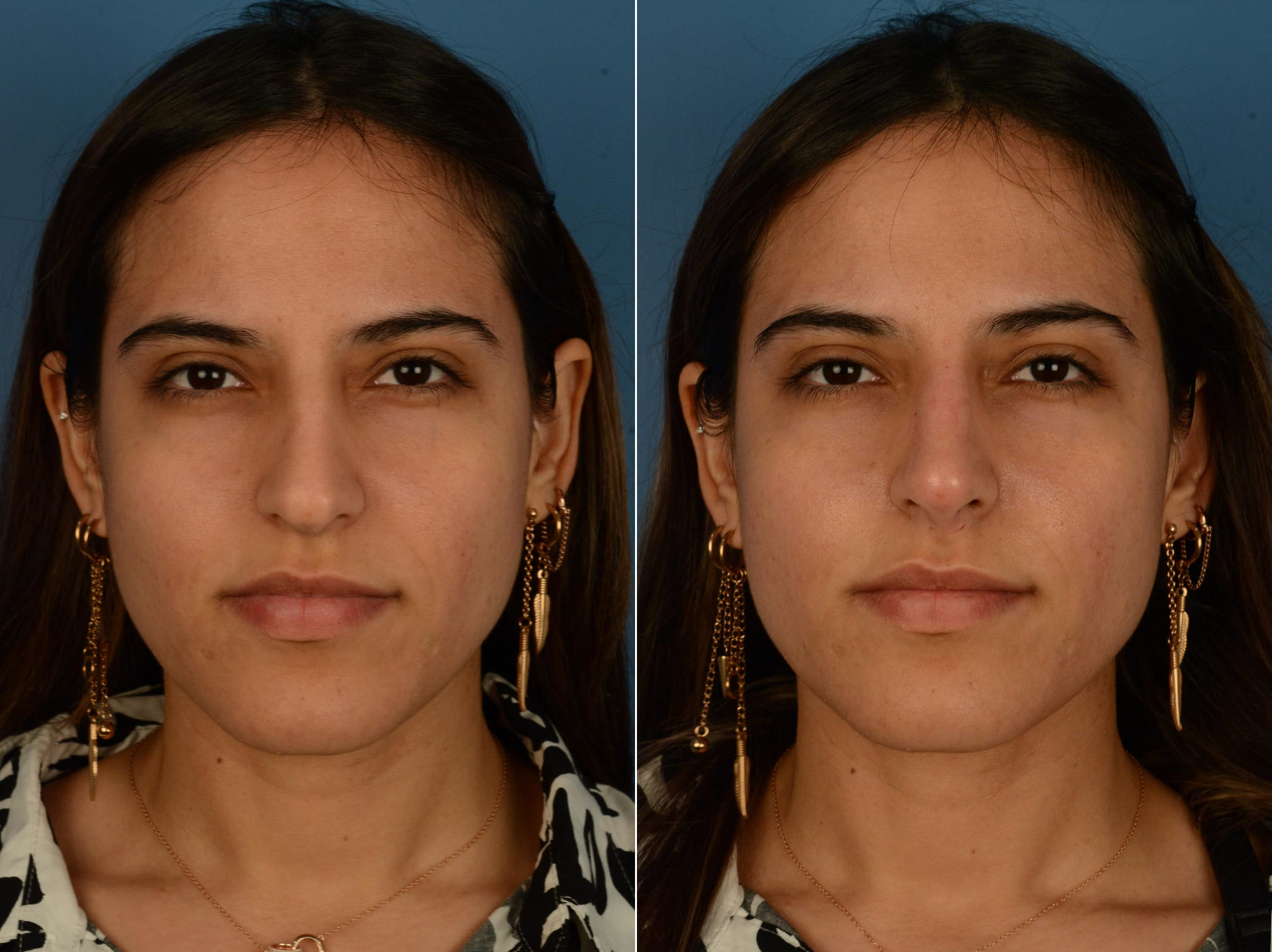 Injectable Filler Rhinoplasty Photos | Naples, FL | Patient 20347