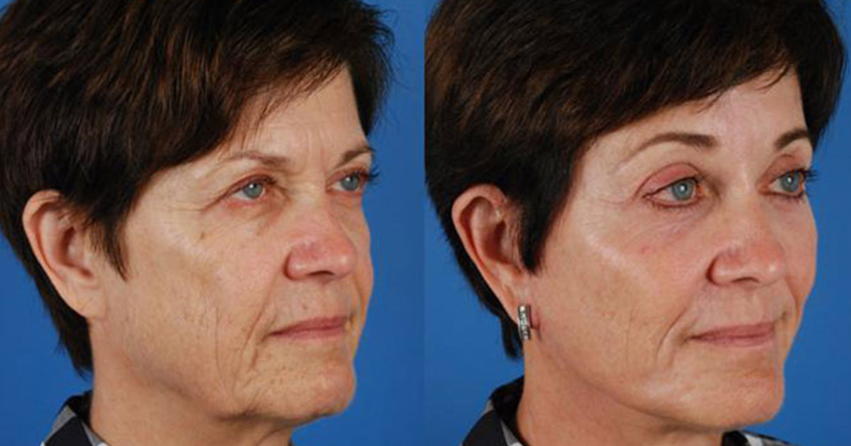 Eyebrow Lift in Naples, FL | Aesthetic Surgery Center