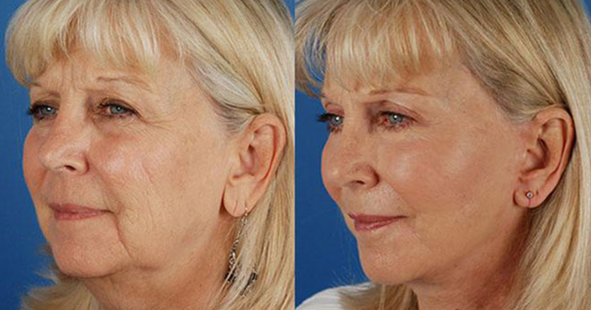 Midface Lift in Naples, FL | Aesthetic Surgery Center