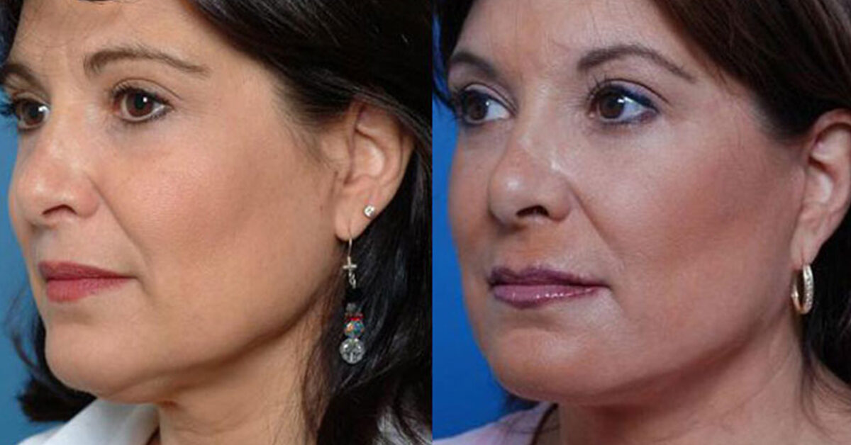 UpLift™ Facelift | Naples, FL