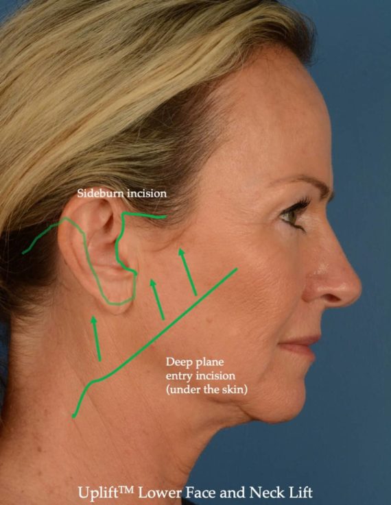 Endoscopic Midface Lift vs Deep Plane Facelift vs Uplift™