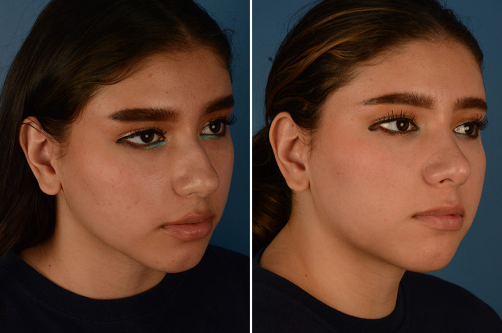 What Age Can You Get Rhinoplasty? | Naples FL Surgeon