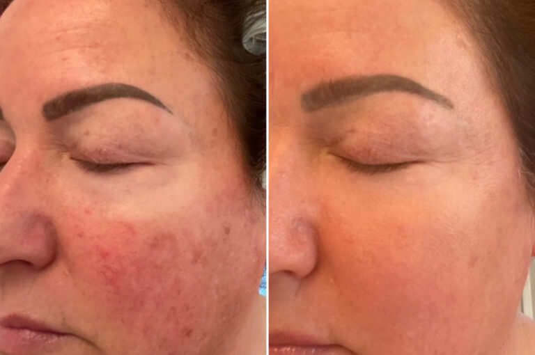 How to Restore Collagen in the Face and Reverse Signs of Aging