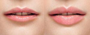 The Benefits of Fat Transfer Lip Augmentation for Fuller Lips