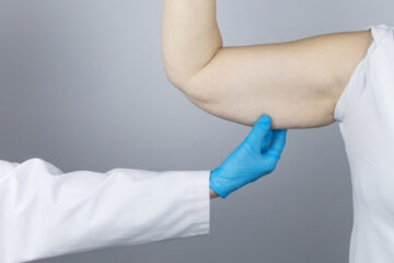 Brachioplasty Scars: What to Expect and How to Manage Them