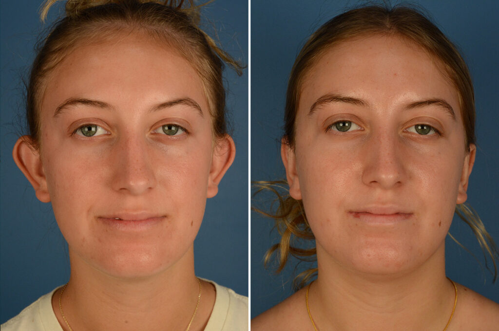 What Can You Expect During Your Otoplasty Recovery?